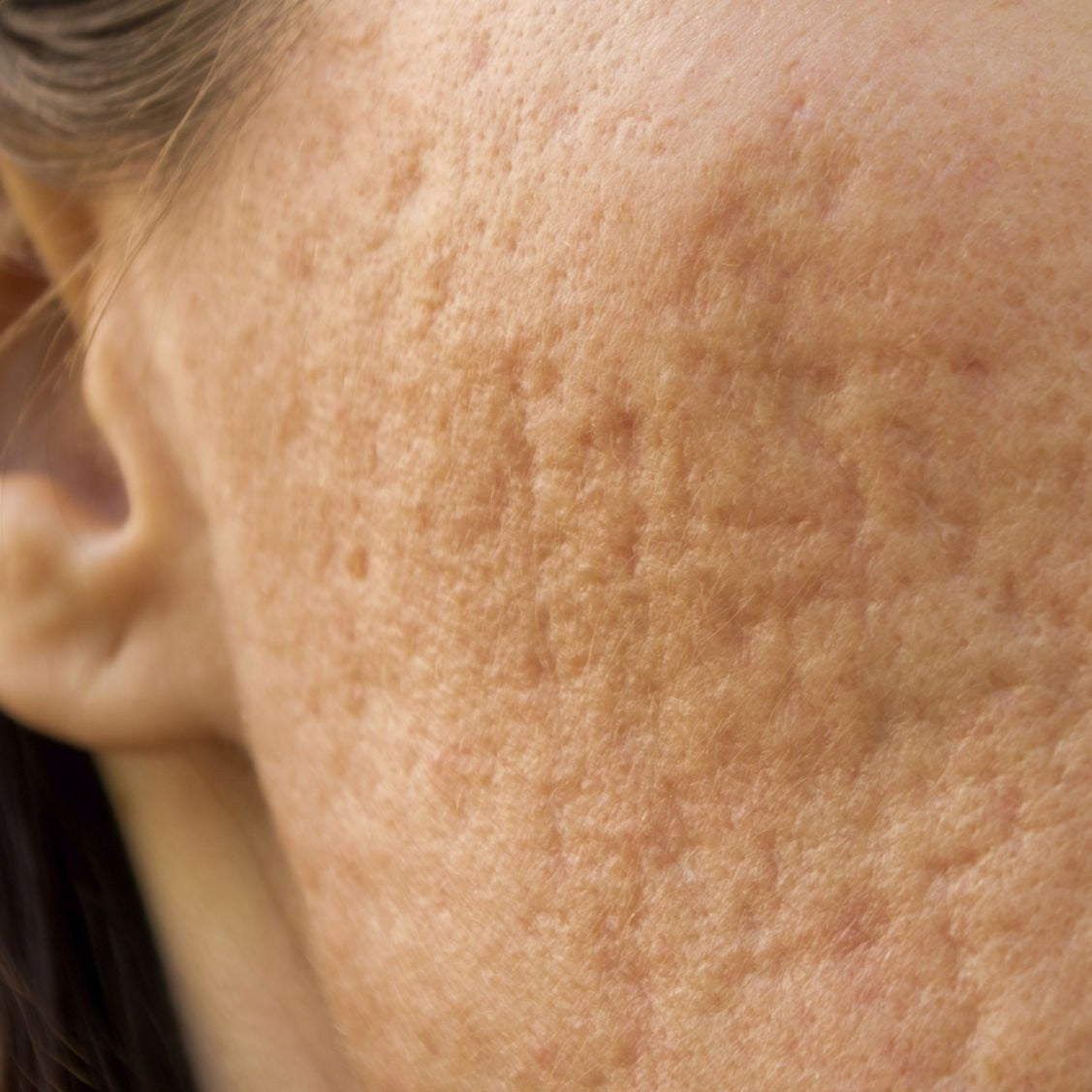 How to Treat Acne Scarring: Professional Skincare Solutions That ...